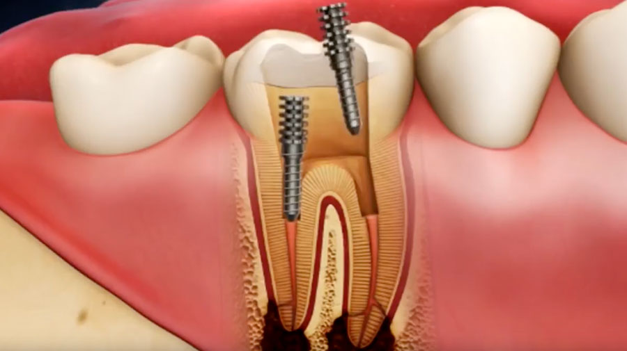 Tratamiento de Conducto | UnoSalud